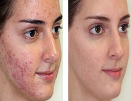 BEST COSMETIC HOSPITALS | Laser Acne Removal