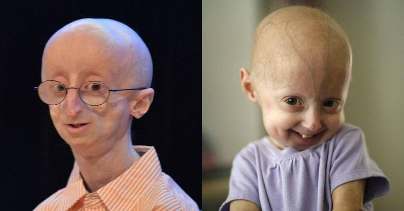 Understanding Progeria (Hutchinson-Gilford Syndrome): Causes, Symptoms, Myths, and Treatments ...